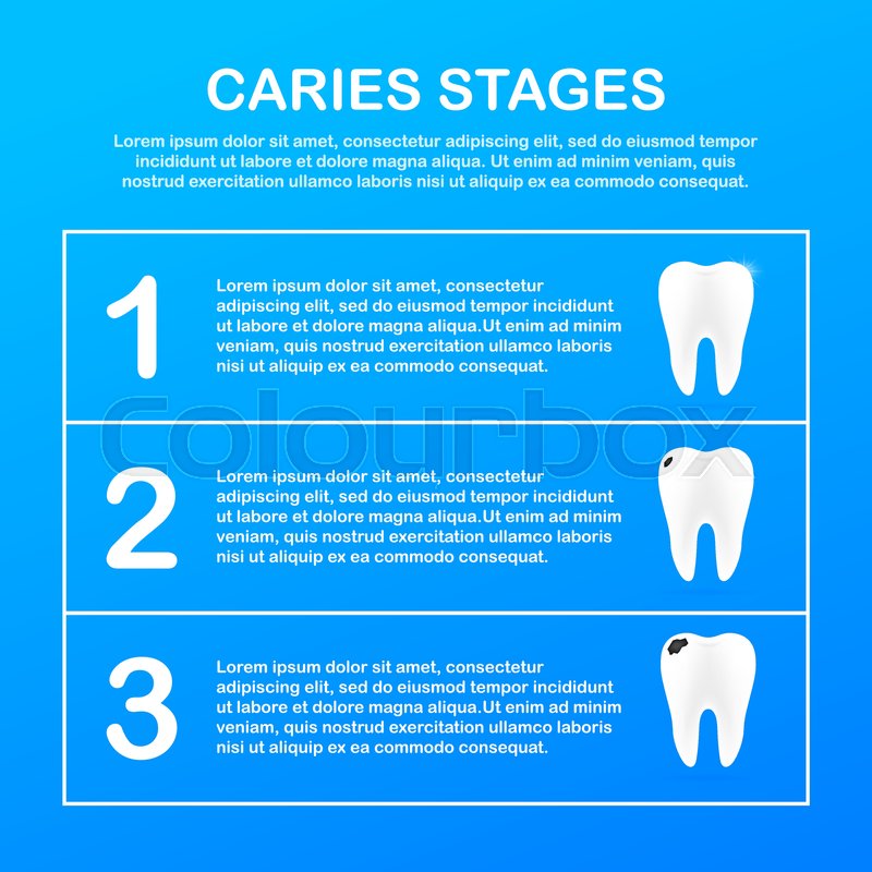 Stage of development of caries. Dental ... | Stock vector | Colourbox