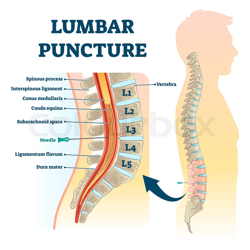 Lumbar puncture vector illustration. ... | Stock vector | Colourbox