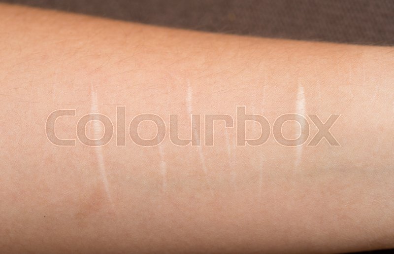 Hand with cuts after suicide attempt | Stock image | Colourbox