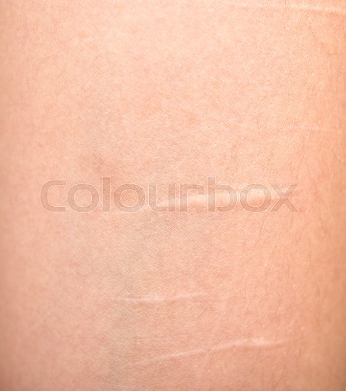 Scars on a human skin | Stock image | Colourbox