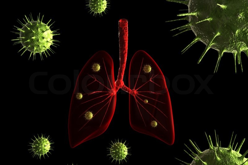 Virus infection in lungs | Stock image | Colourbox