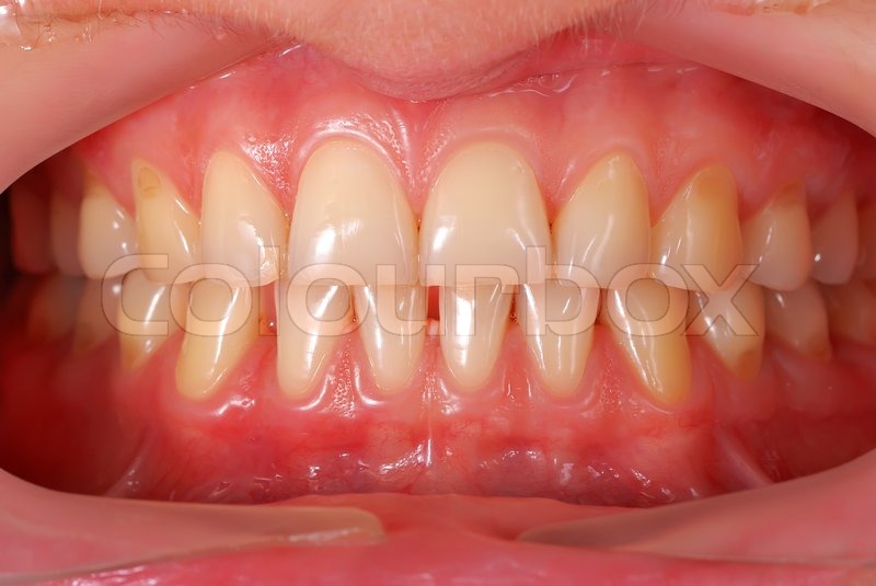 Human teeth | Stock image | Colourbox