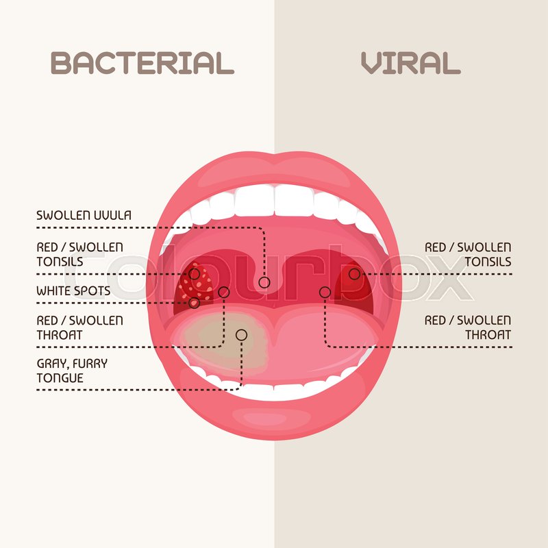 Bacterial Tonsillitis Vs Viral Tonsillitis