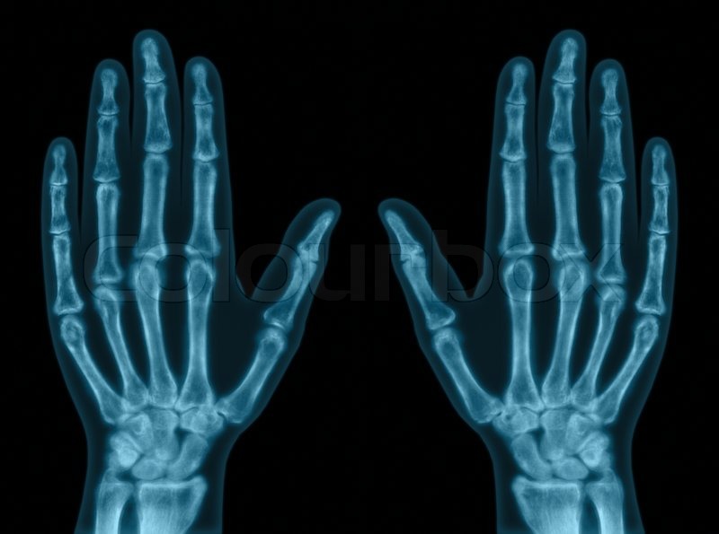 Hand-Knochen | Stock Bild | Colourbox