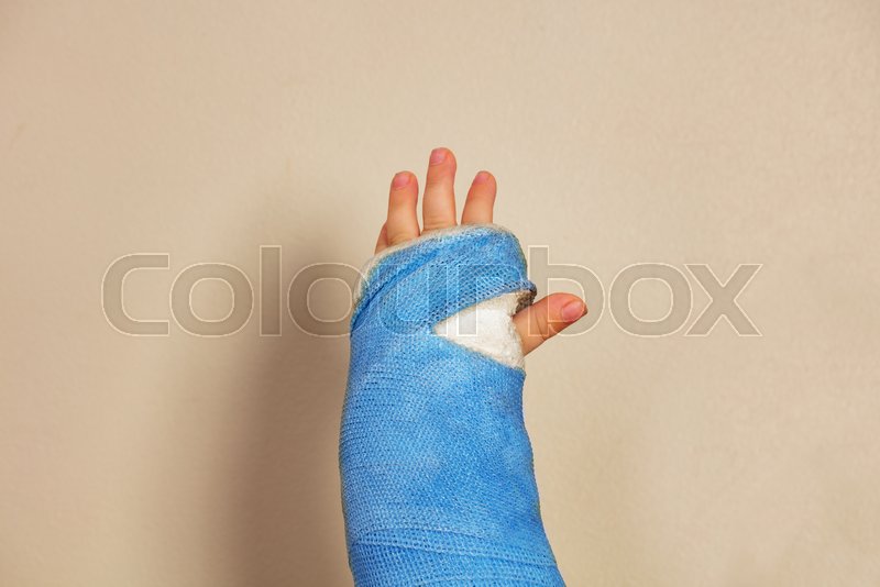 Broken Hand Cast
