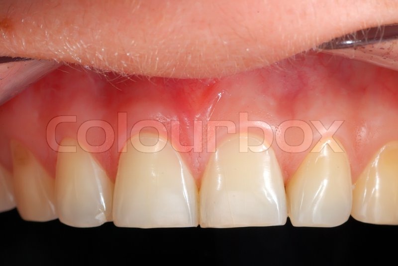 Human teeth | Stock image | Colourbox