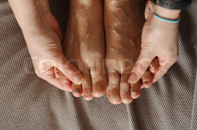 Toenail Problems During Chemo