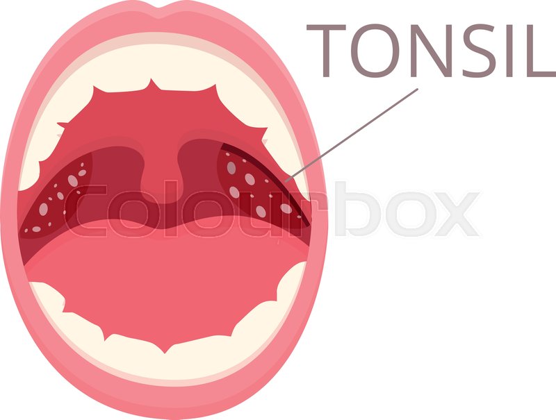 Tonsil Stones Diagram