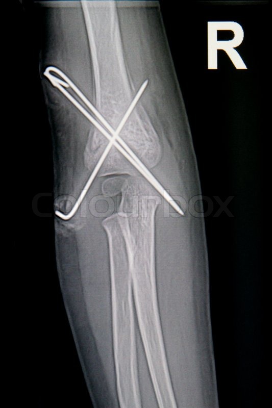 Underarm røntgenstråler billede, der ... | Stock foto | Colourbox