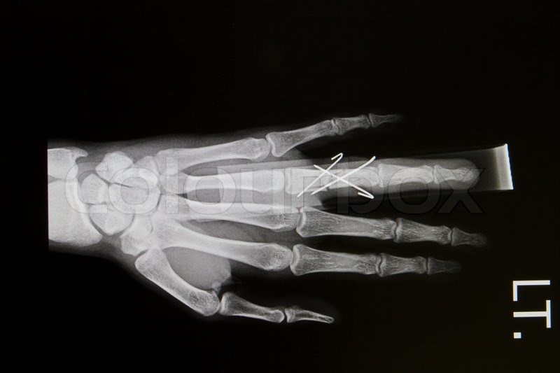 Hand x-rays image showing wire fixation ... | Stock image | Colourbox