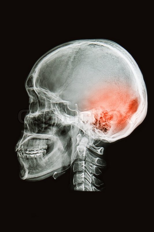 Skull x-rays imagesagital plane show ... | Stock image | Colourbox