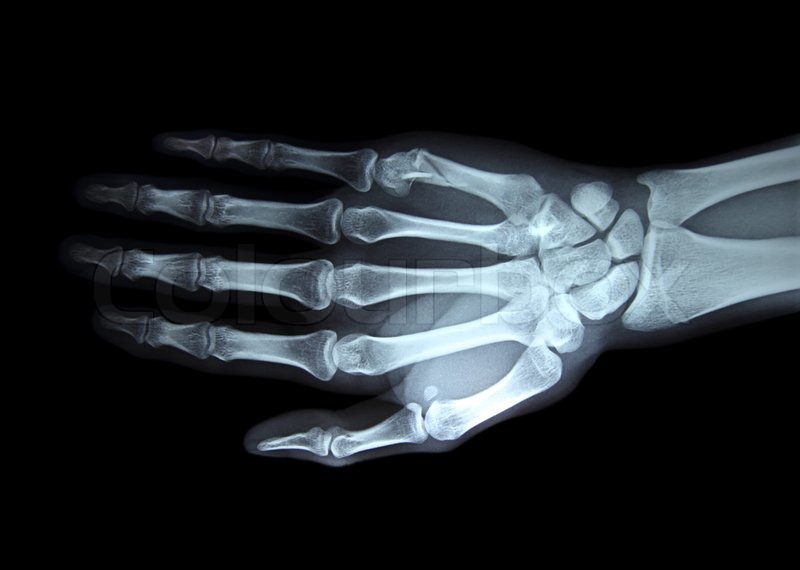 X-ray right hand | Stock Photo | Colourbox