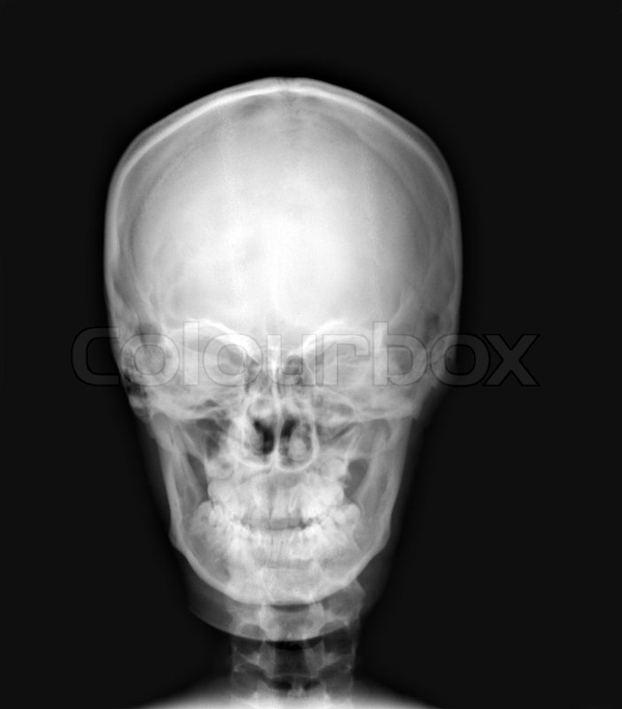 Detail of neck and head x-ray image | Stock image | Colourbox