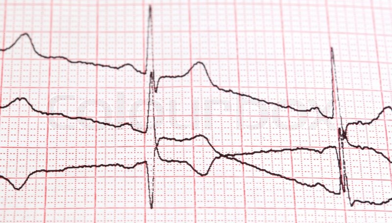 EKG | Stock Bild | Colourbox