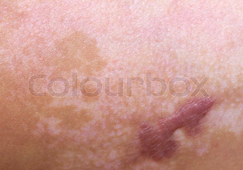 Scar from a burn on the skin | Stock image | Colourbox