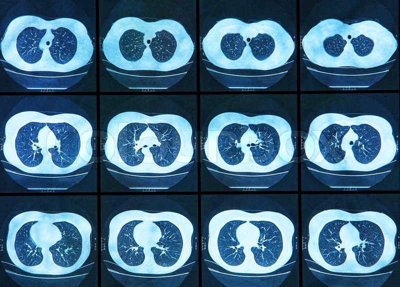 Magnetic resonanse image of chest | Stock image | Colourbox