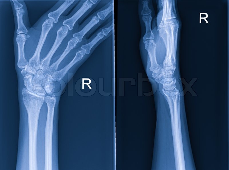 Right Hand X Ray Normal
