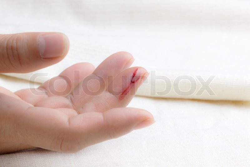 Injured finger with bleeding open cut | Stock image | Colourbox