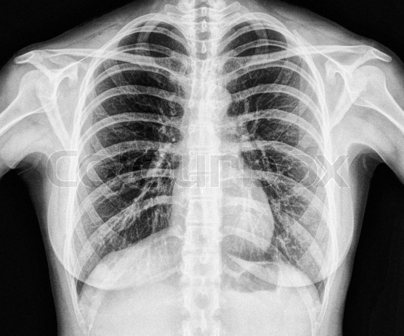 X-Ray Image Of Human Healthy Chest MRI | Stock image | Colourbox