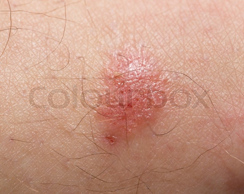 Ringworm of the skin. macro | Stock image | Colourbox