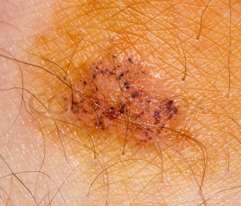 Ringworm of the skin. macro | Stock image | Colourbox