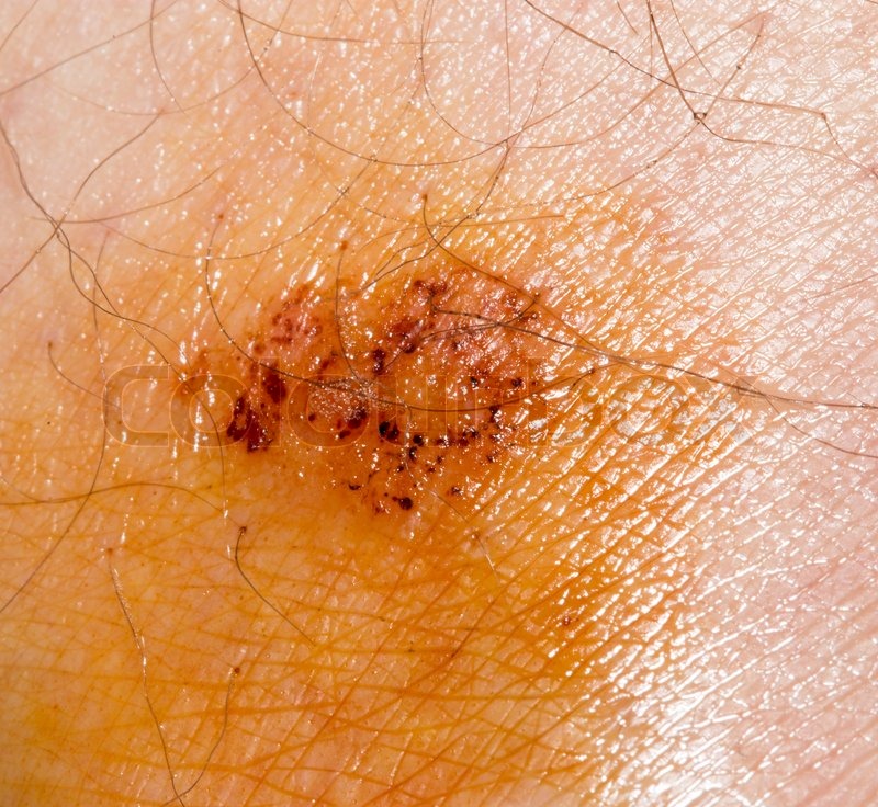 Ringworm of the skin. macro | Stock image | Colourbox
