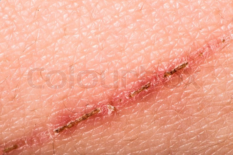 Texture of human skin and scratch. ... | Stock image | Colourbox