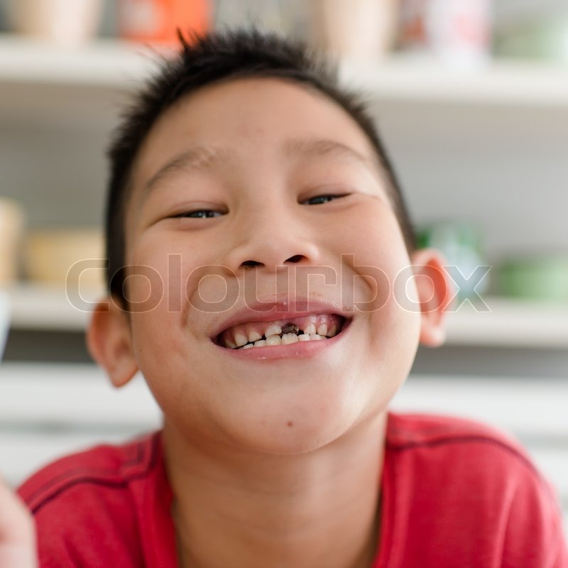 Little Asian boy and broken teeth. | Stock Photo | Colourbox