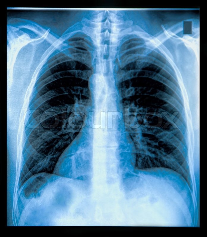 X-Ray image if the human chest | Stock image | Colourbox