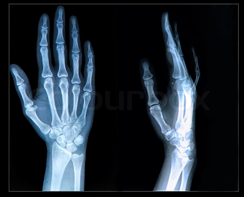 Xray of human Hand/ fingers | Stock image | Colourbox