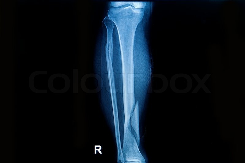 X-ray image show fracture both bone of ... | Stock image | Colourbox