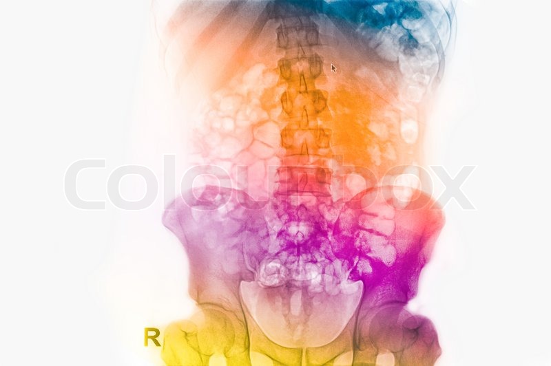 Colorful pelvic and spinal column ... | Stock image | Colourbox